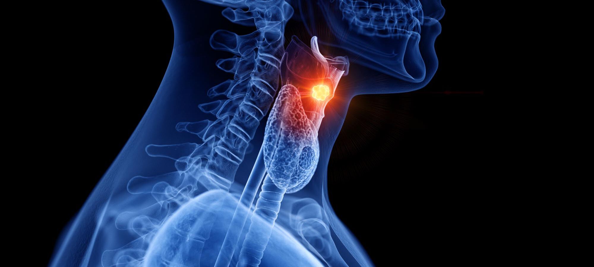 Halszystenentfernung - HNO Zentrum Frankfurt am Main